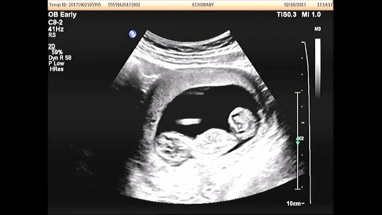 2D Pretecho Tweeling 12 Weken, met ingesproken uitleg - YouTube