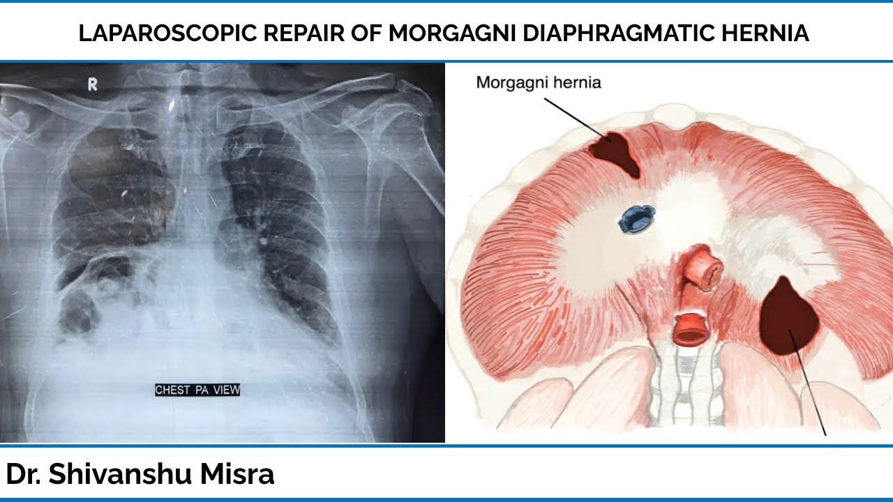 LAPAROSCOPIC REPAIR OF MORGAGNI DIAPHRAGMATIC HERNIA - YouTube