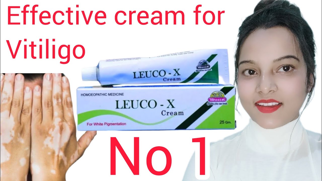 FOR vitiligo cream।। leuco x cream for leucoderma।। weezal leuco x ...