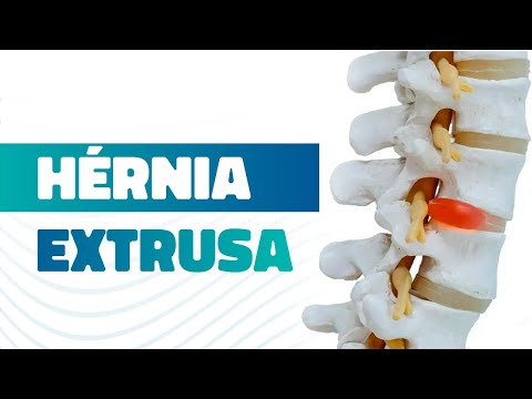 Hérnia Extrusa | Marcelo Garcia - YouTube