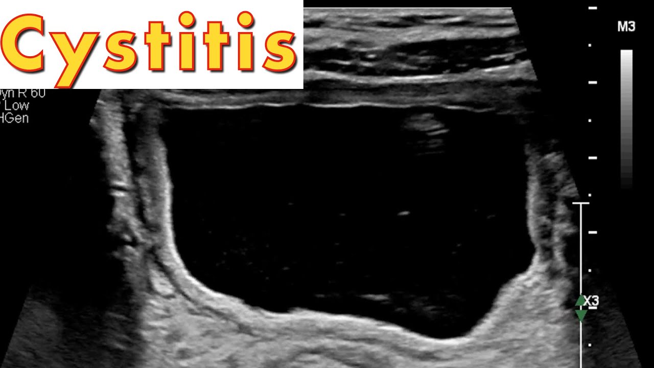 Cystitis on ultrasound - YouTube