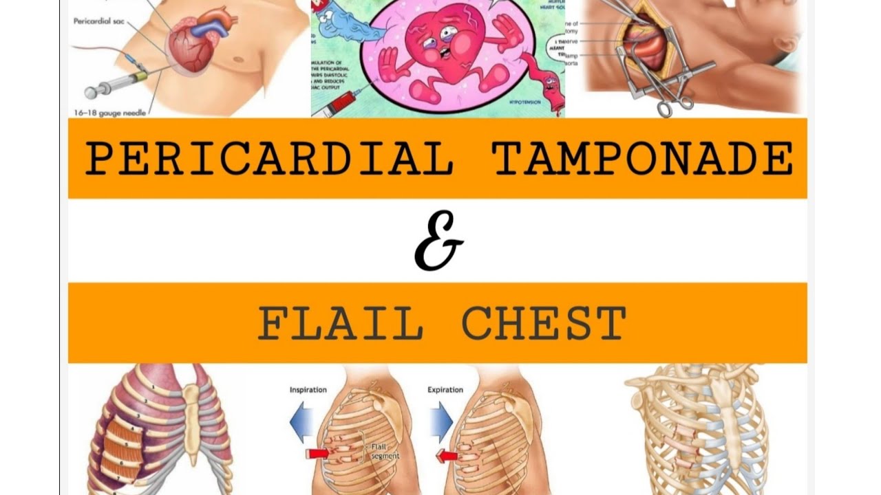 PERICARDIAL TAMPONADE & FLAIL CHEST - YouTube