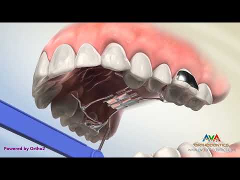 Orthodontic Expander or Spacer   Hyrax Appliance (Sabit Üst Genişletme Apareyi-2)