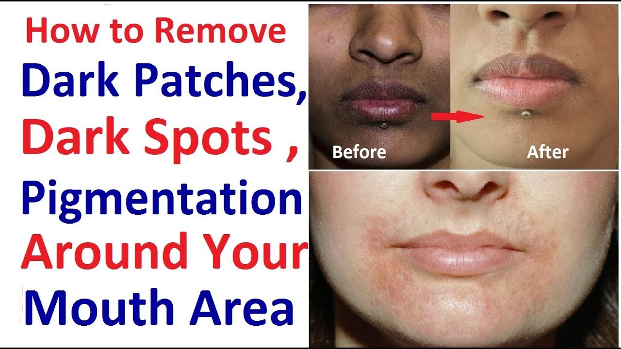 How To Remove Dark Patches Dark Spots Pigmentation Around Your Mouth how-to-remove-dark-patches-dark-spots-pigmentation-around-your-mouth