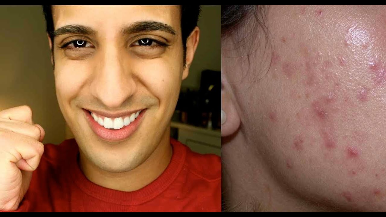 So bekämpfst DU Akne&Pickel für IMMER! 5 Geheimtipps!! - How To Get Rid ...