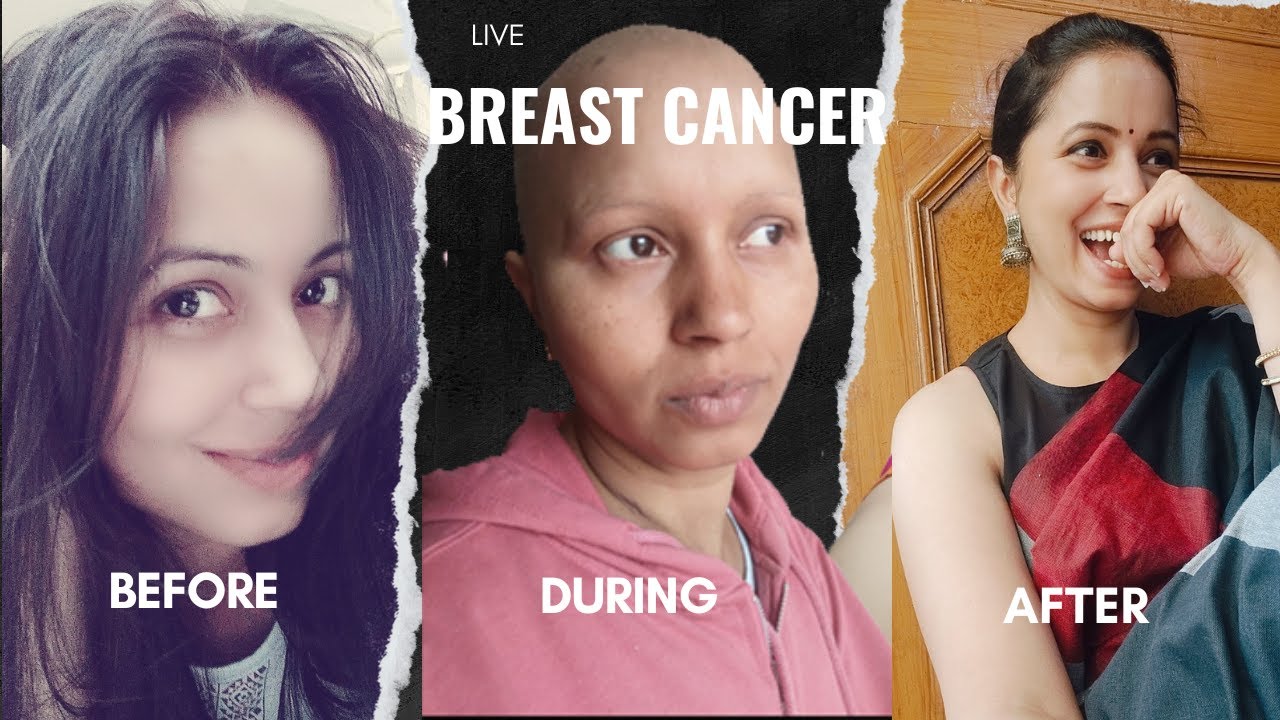 My triple negative breast cancer journey and your questions🙋 - YouTube