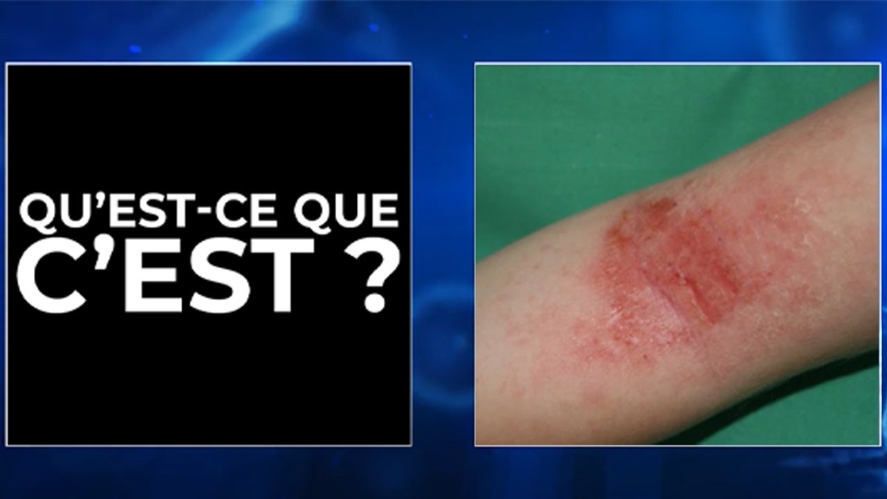Eczéma atopique - YouTube
