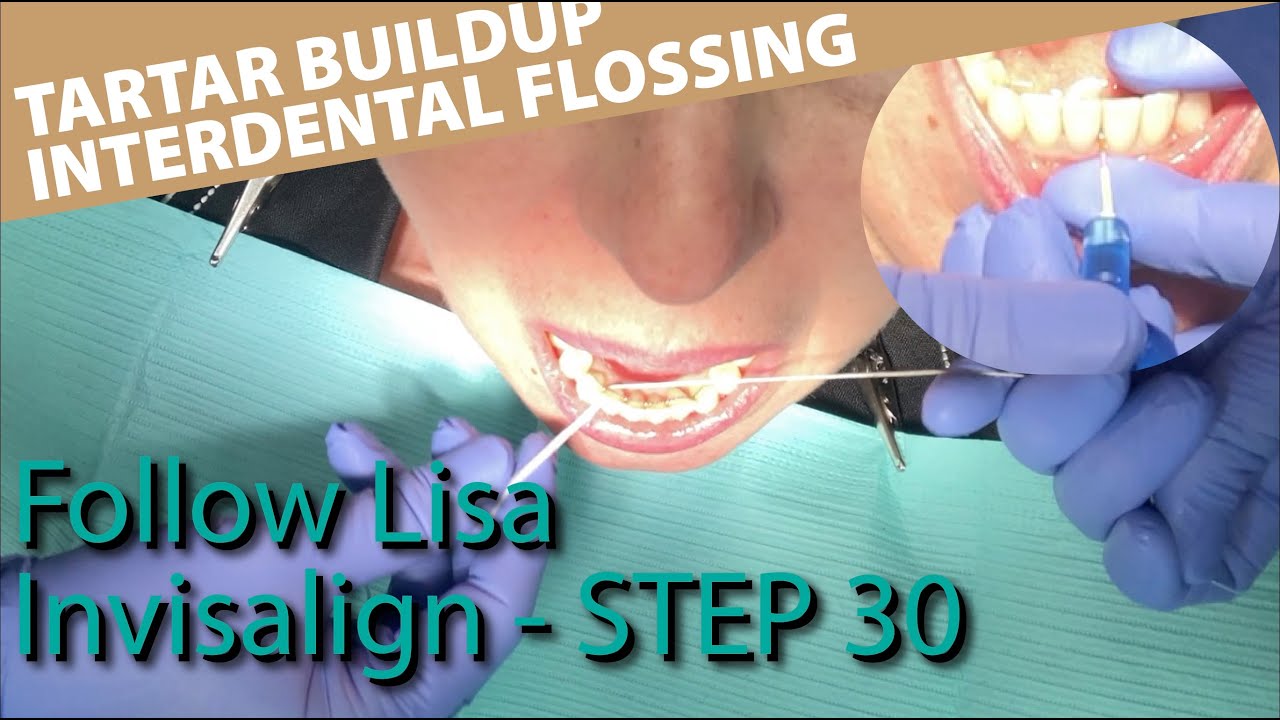 🦷 Invisalign 30 - POST WIRE: Tartar buildup and interdental flossing ...