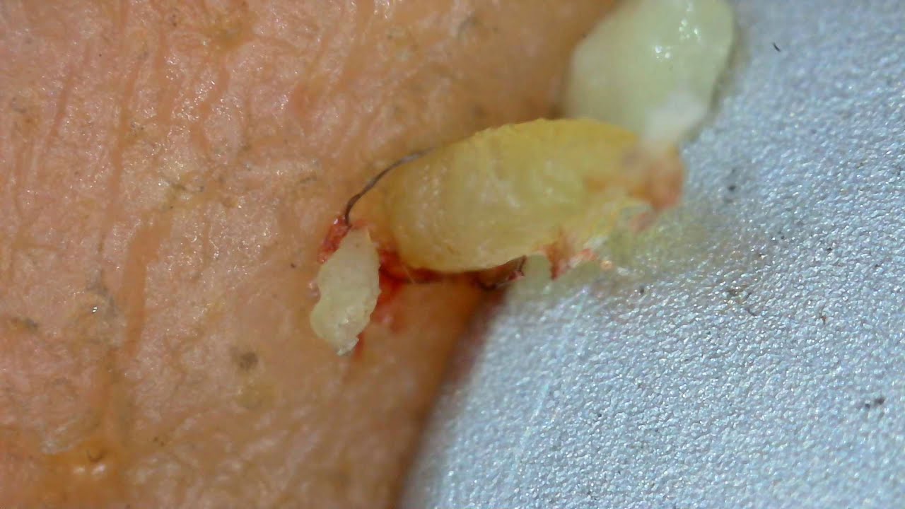 0330 keratin plug removal nose - YouTube