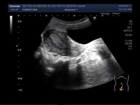 Ultrasound Video showing a polyp in Uterus with an ovarian Cyst. - YouTube