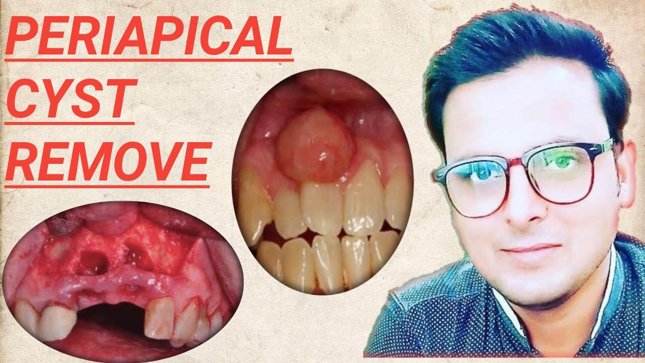 Periapical cyst remove upper teeth"Teeth Talk Boy - YouTube