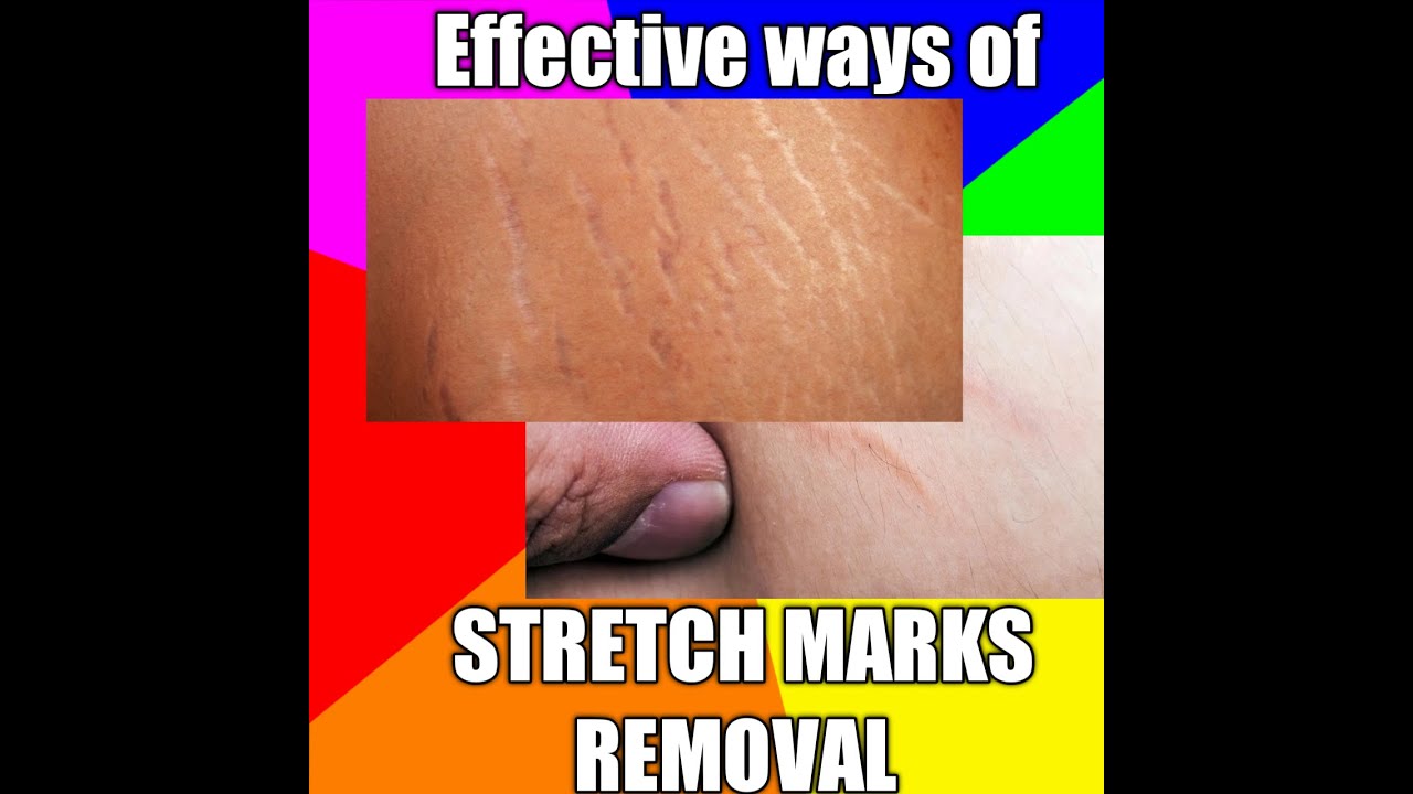 স্ট্রেচ মার্ক দূর করার উপায়।।how To Remove Stretch Marks Fast Youtube