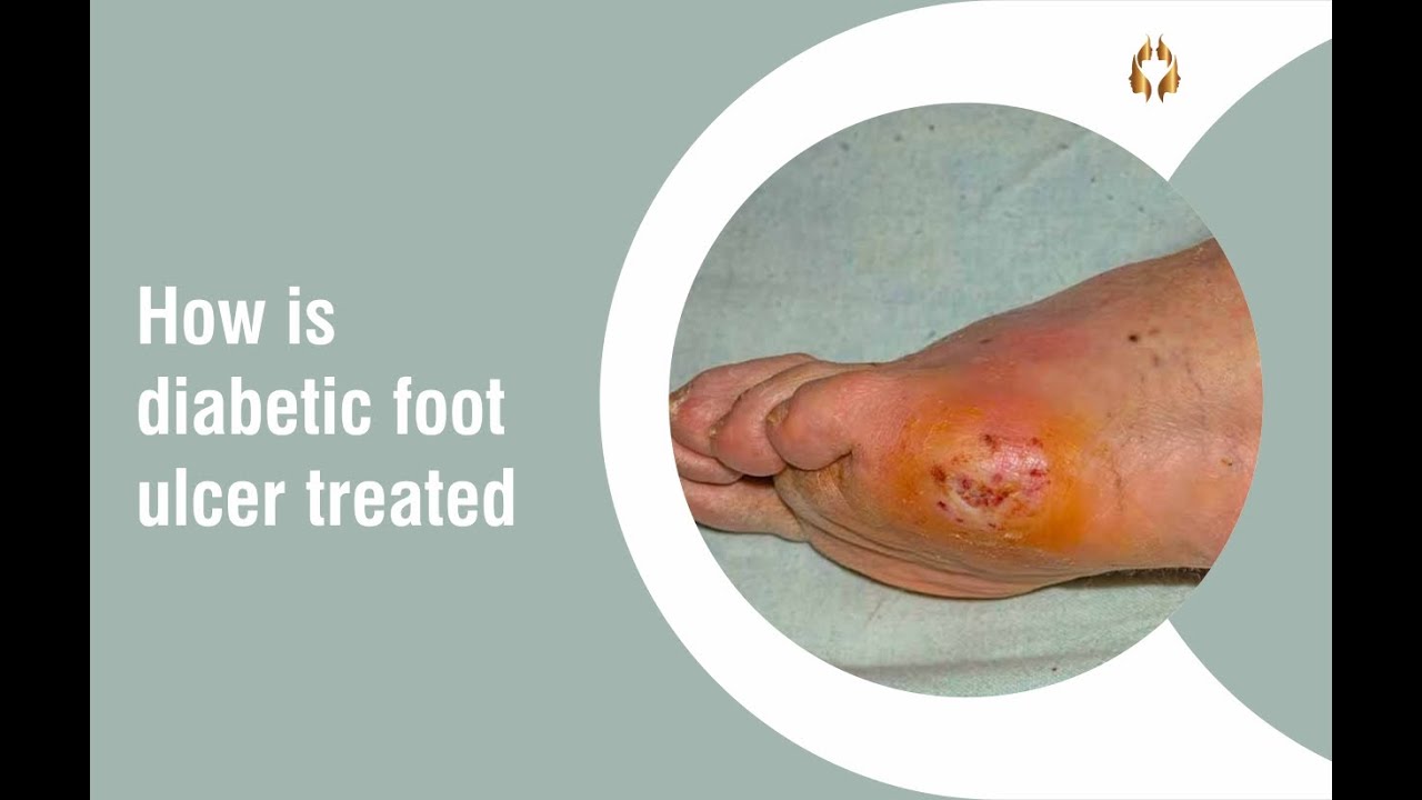 MMRV Hospital - Best diabetic Foot Ulcer Treatment | Diabetic Foot Care ...