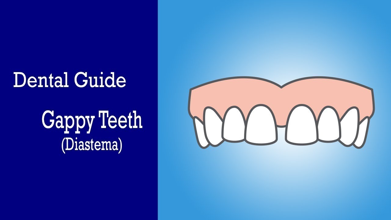 What is a Diastema? | BOH Dental Guide to Gapped Teeth - YouTube