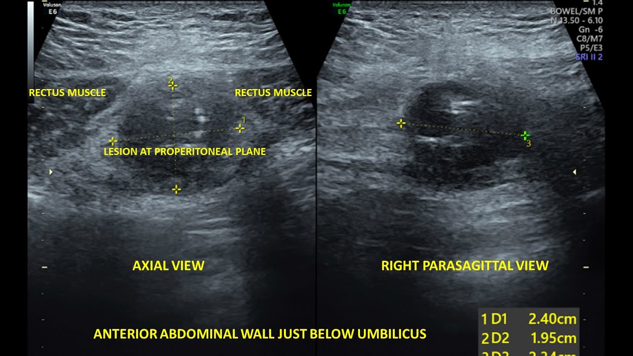 Umbilical-urachal sinus with abscess in properitoneal plane ...