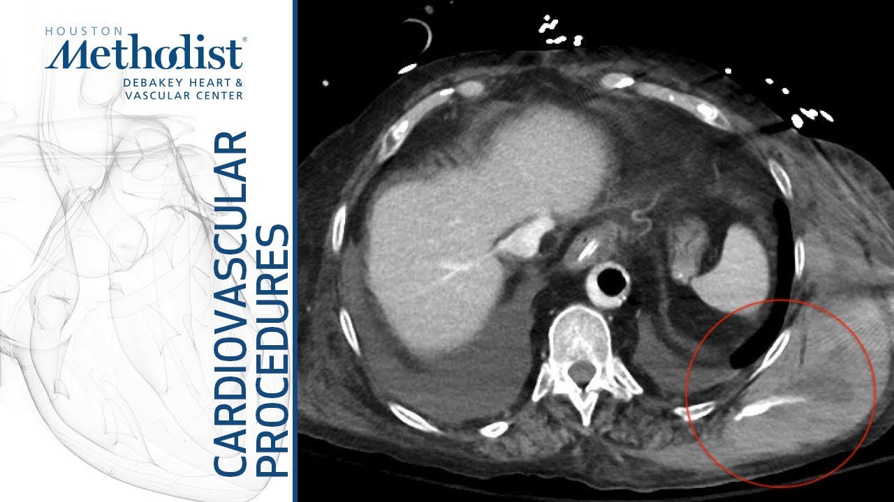 Embolization of a Bleeding Intercostal Artery (Lumsden, MD, Chinnadurai ...