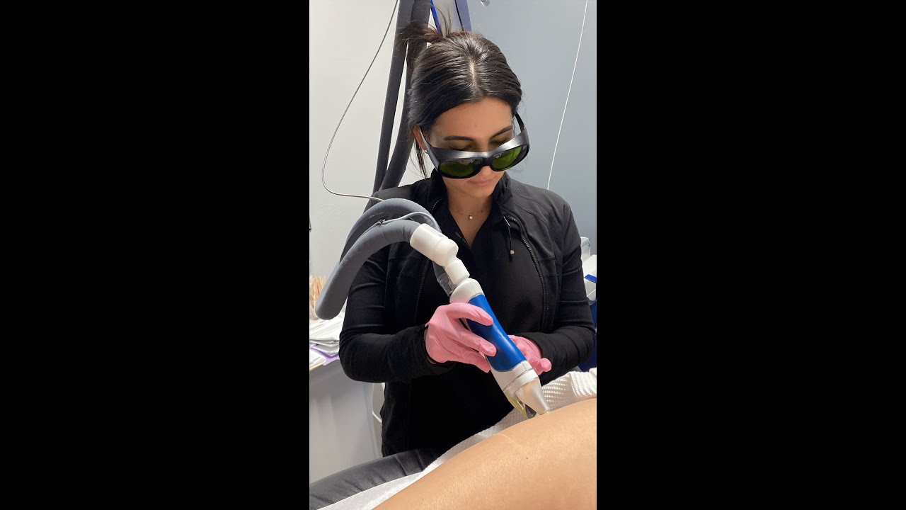 Splendor X Laser Hair Removal Machine Cost at Diane Arnett blog