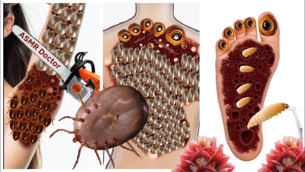 ASMR tick & maggots removal animation - YouTube
