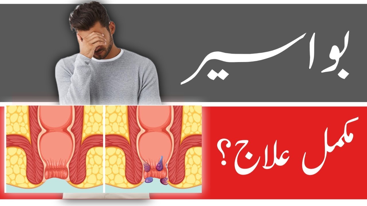 Hemorrhoids/Bawaseer | Kya Surgery k bagair ilaj mumkin hai? - YouTube
