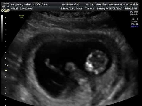 Amazing 11 week ultrasound! - YouTube