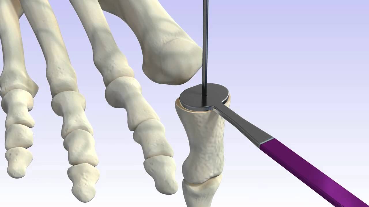Metasurg BioMotion 1st MPJ Hemi Implant System - YouTube