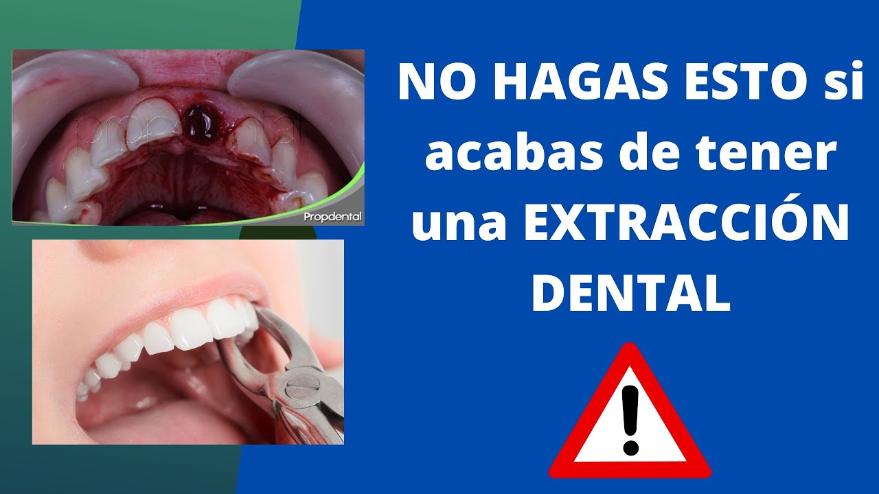 EXTRACCIÓN DENTAL SIMPLE | Lo que NO debes hacer - YouTube