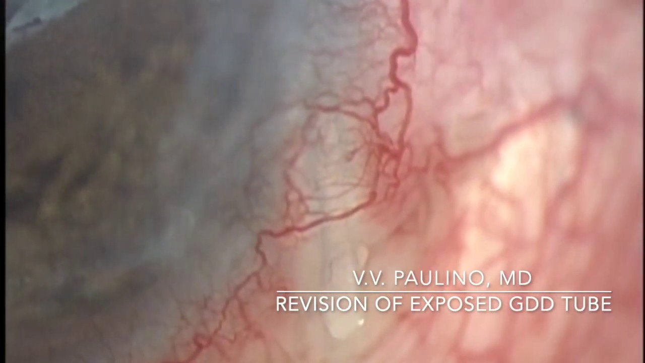 Revision of GDD Tube - YouTube