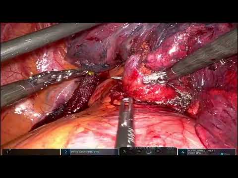 LOBECTOMIA PULMONAR SUPERIOR IZQUIERDA VIA ROBOTICA - YouTube