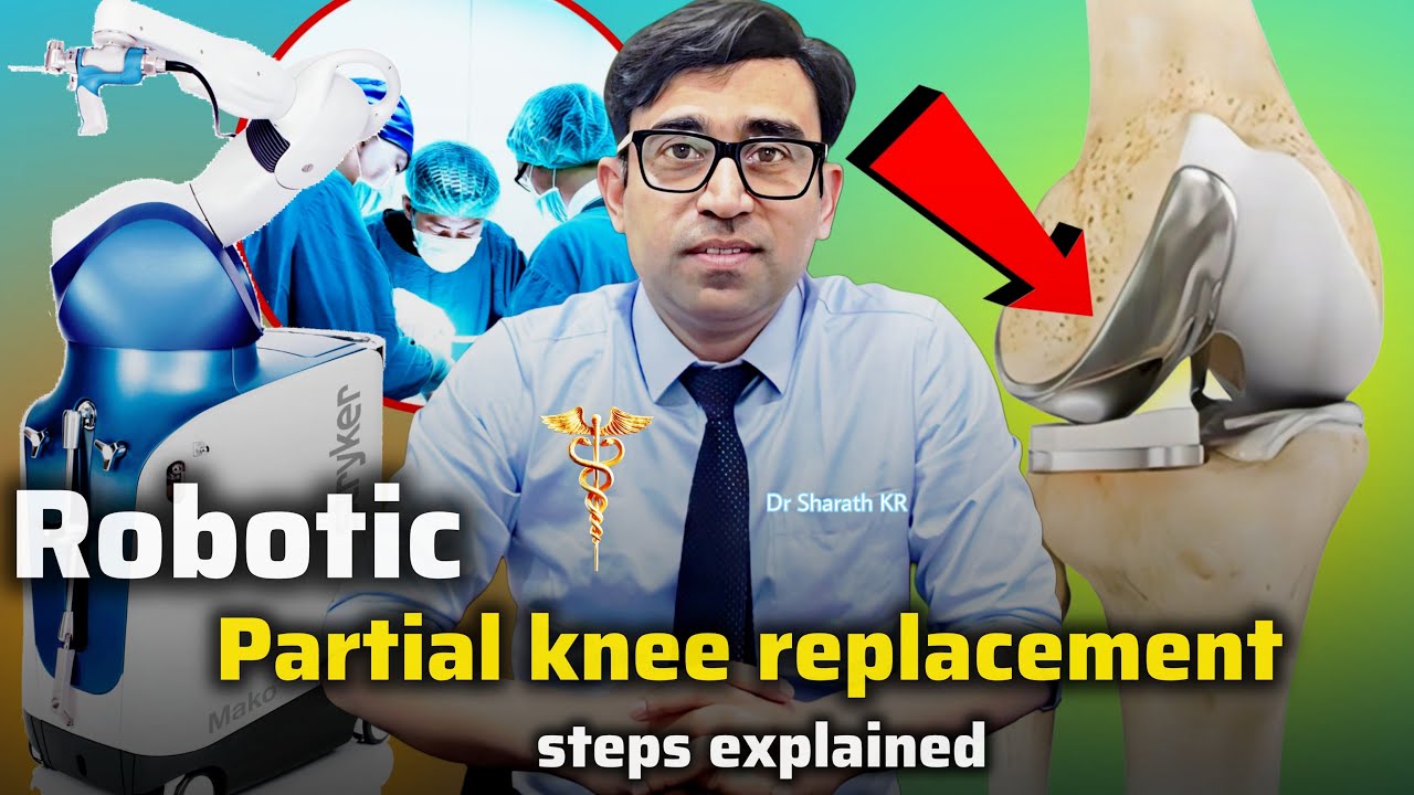 Robotic / MAKO Partial Unicondylar Knee Replacement. - YouTube
