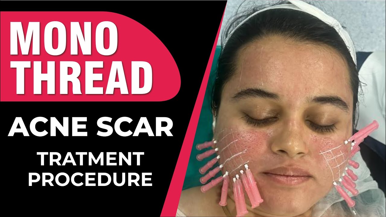 Treating Acne Scars with PDO Smooth Threads | Acne Scar Treatment with ...