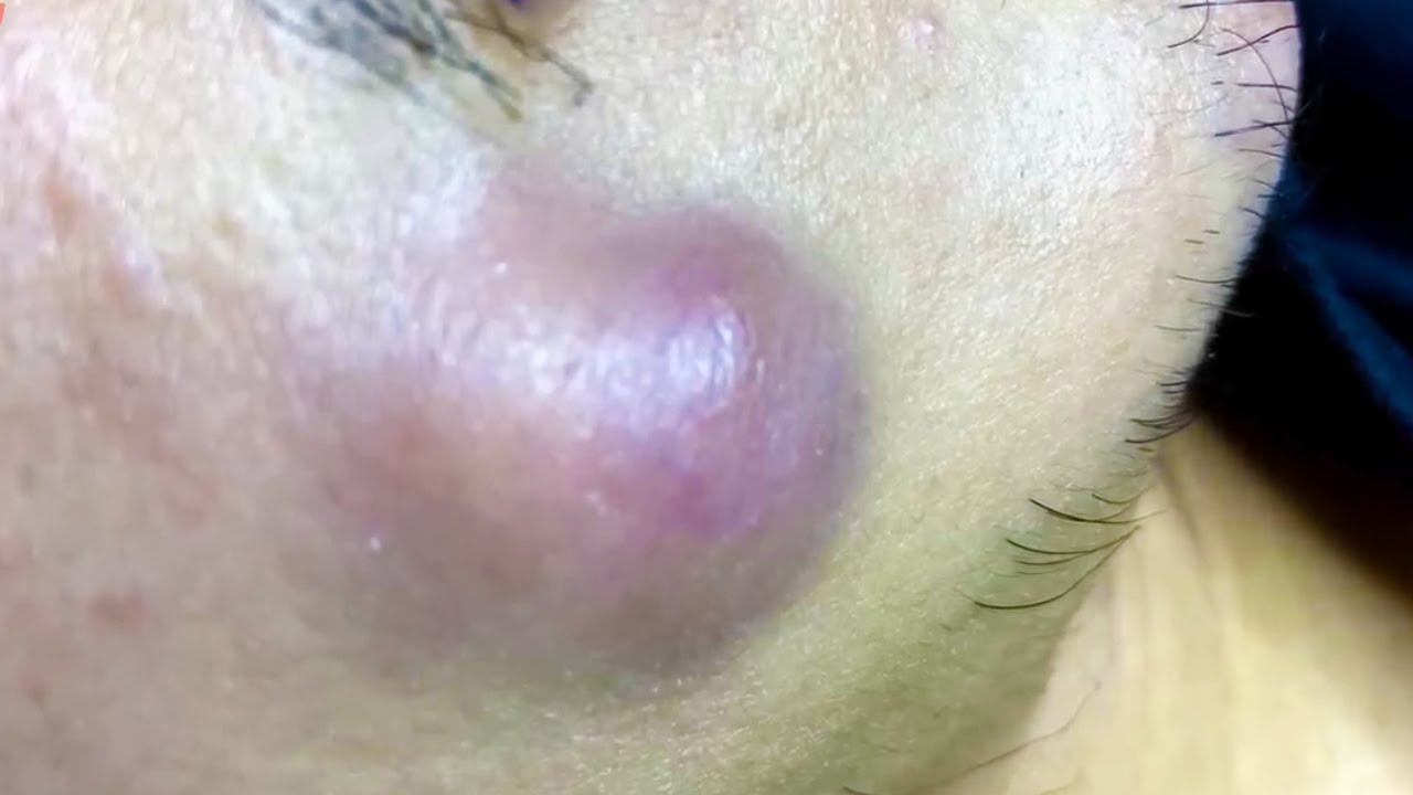 Large subcutaneous acne - YouTube