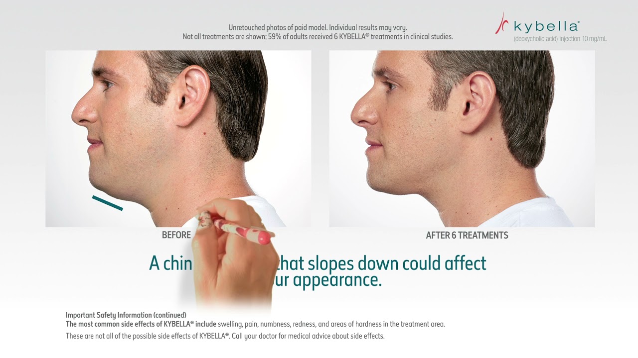 KYBELLA® (deoxycholic acid) injection - YouTube