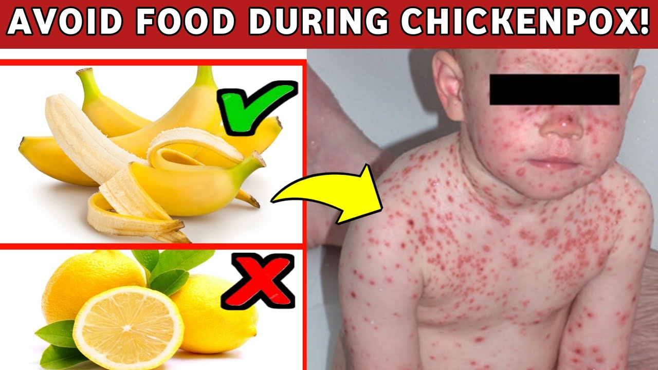 "Foods You MUST Avoid with Chickenpox & What to Eat Instead!" - YouTube