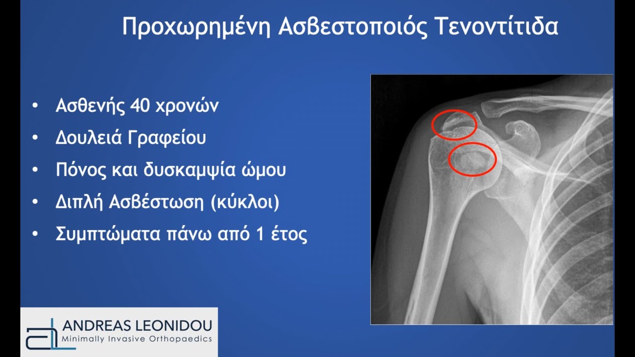 Διπλή Ασβεστοποιός Tενοντίτιδα - YouTube
