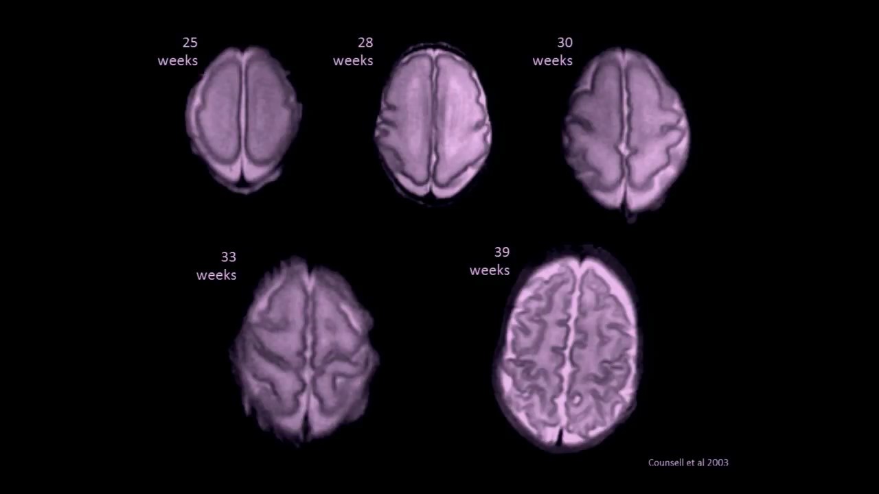 #3 James Boardman: Growing up following premature birth - YouTube