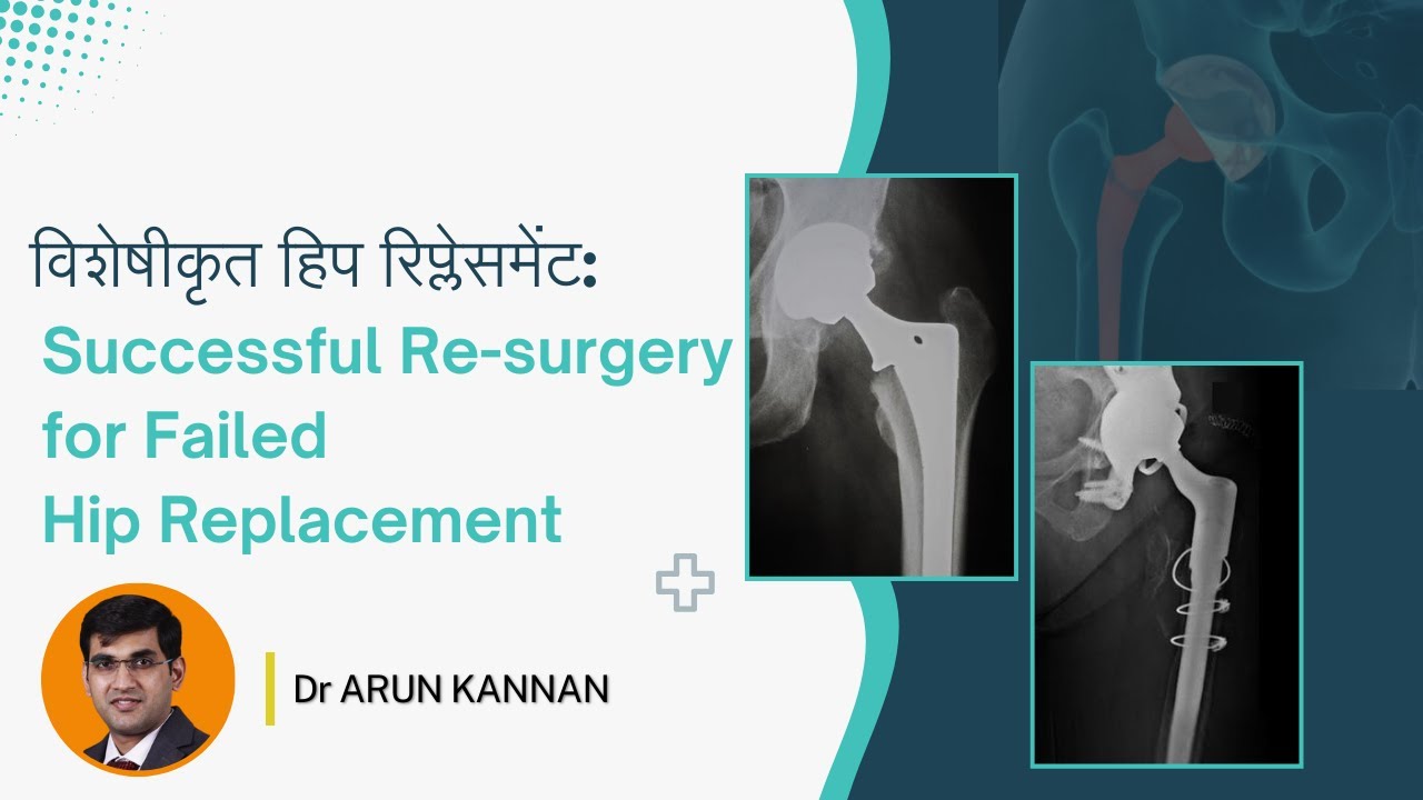 विशेषीकृत हिप रिप्लेसमेंट: Successful Re-surgery for failed hip ...