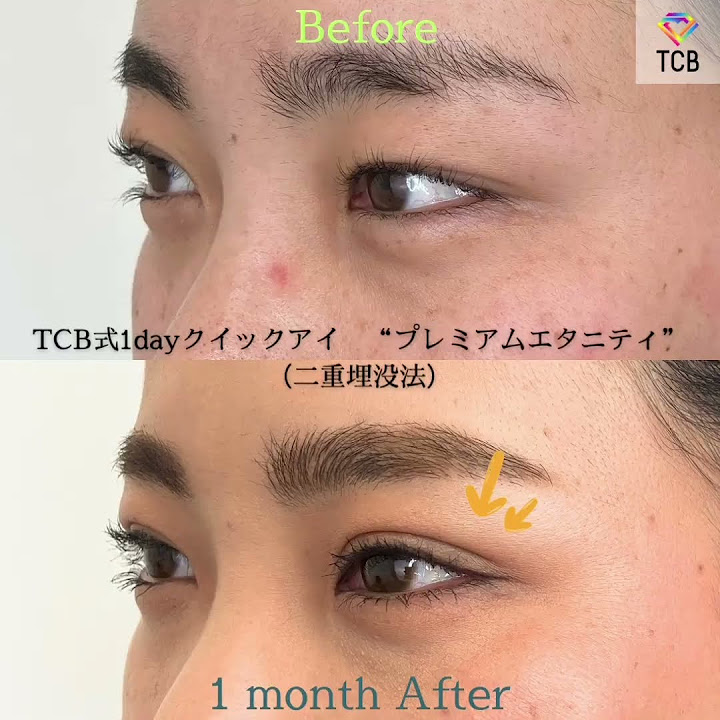 【TCB式1dayクイックアイ（二重埋没法）】#shorts - YouTube