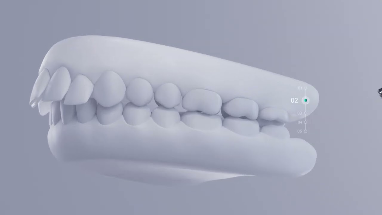 Carriere Motion 3D Class II & Aligners: Doctors Education - YouTube