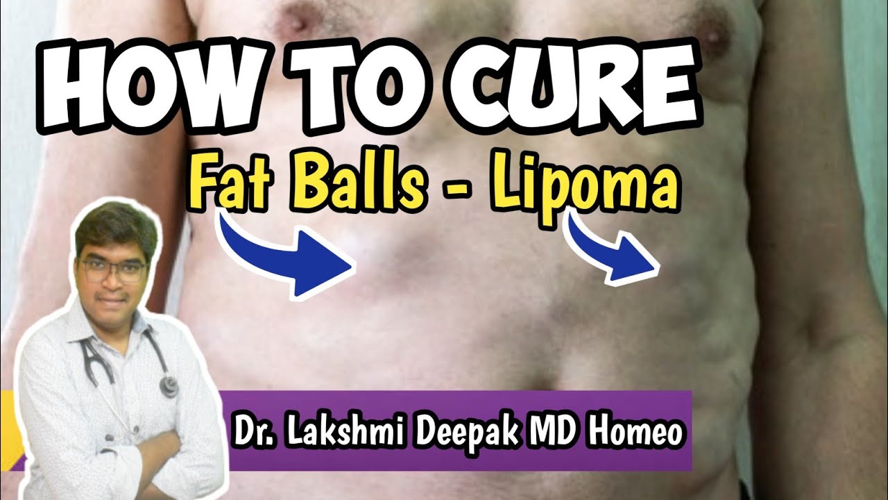How to Cure Fat Balls in my body Lipoma Treatment Homeo medicine - YouTube