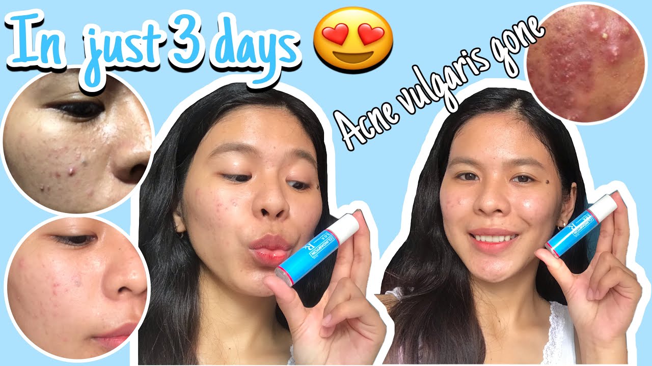 in just 3 days my acne was gone by using CLINDAMYCIN topical solution ...