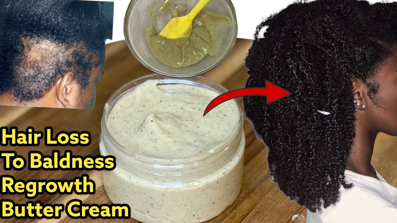 Grow Bald Edge, Best Hair Loss Butter Cream Treatments - YouTube