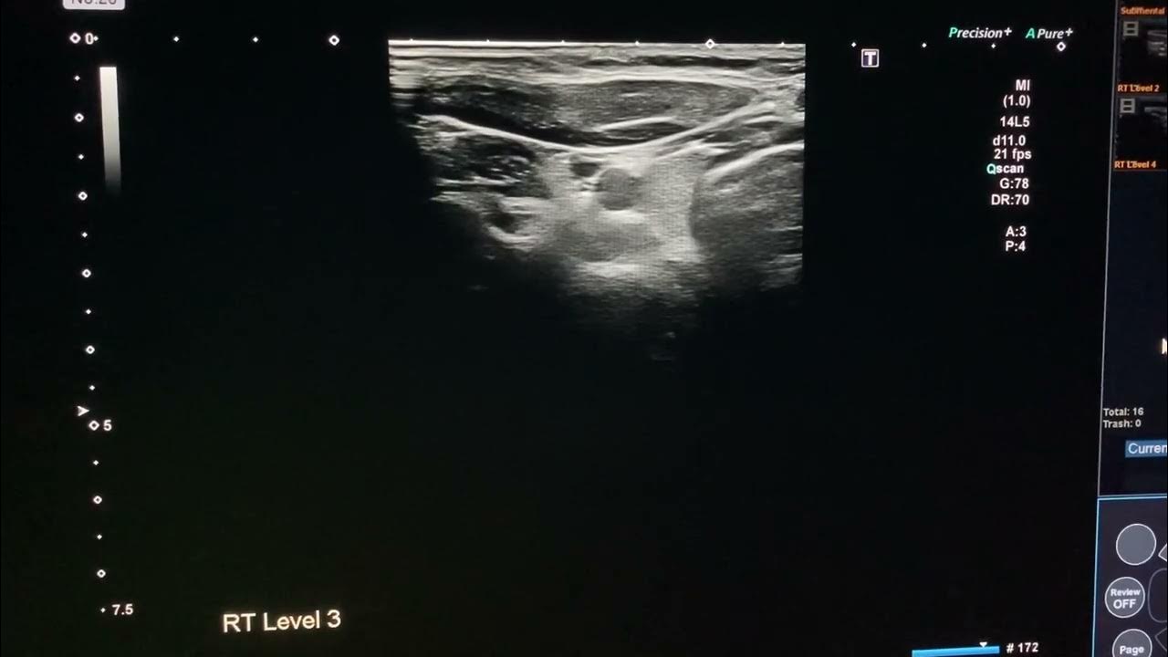 Head And Neck Ultrasound Demonstration Youtube