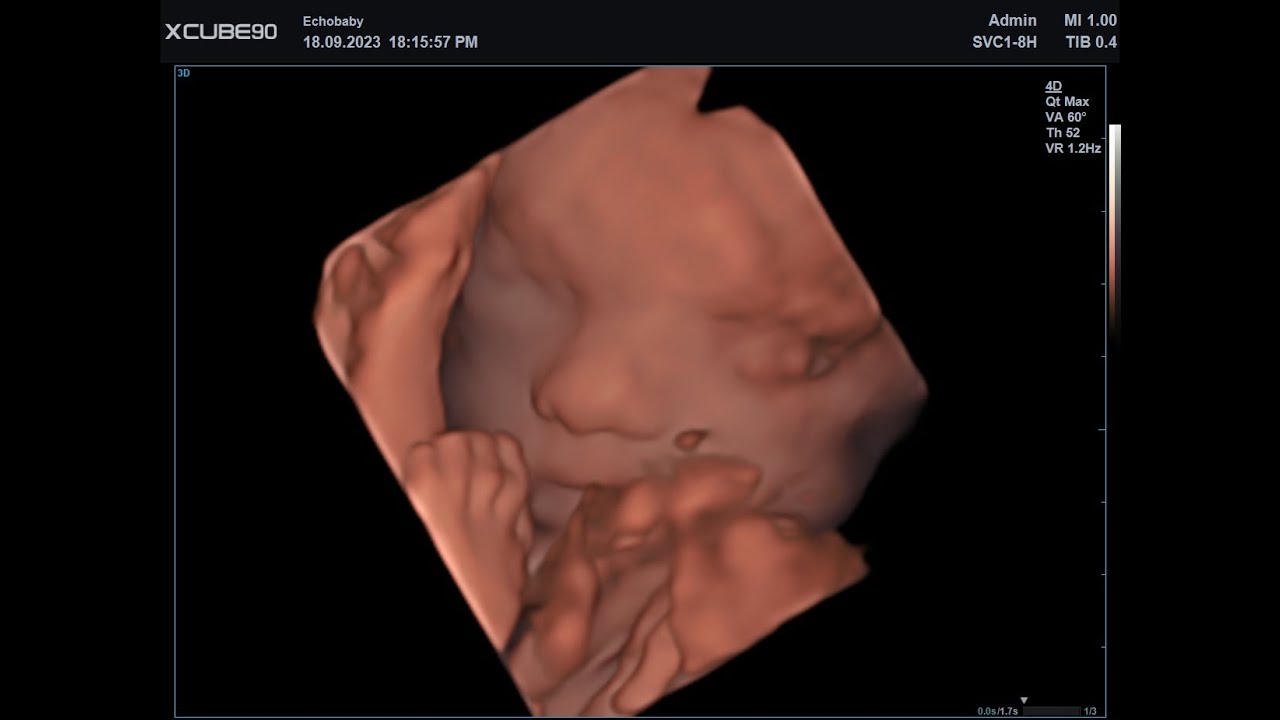 3D Echo 28 Weken Zwanger, Foto's - YouTube