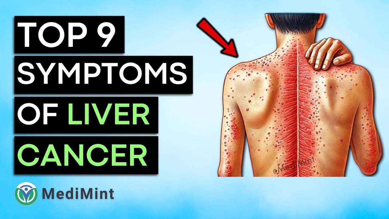 Liver Cancer EXPERT Reveals Top 9 Signs and Symptoms | MediMint - YouTube