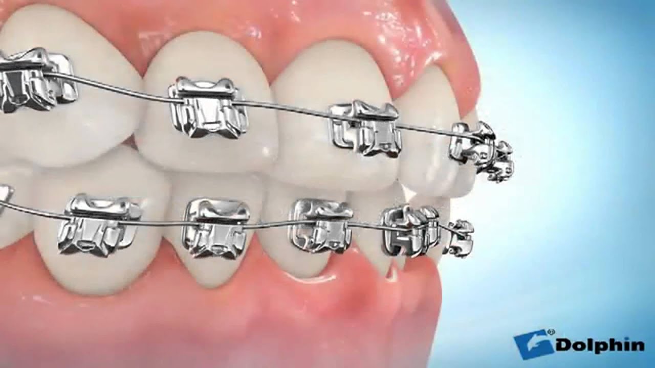 RGVODONTOLASER - ORTODONTIA - AUTOLIGAVEL - Damon System.mp4 - YouTube