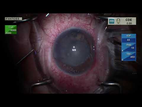 Dr. Cristos Ifantides: ZEPTO® Capsulotomy on a Fibrotic Capsule - YouTube