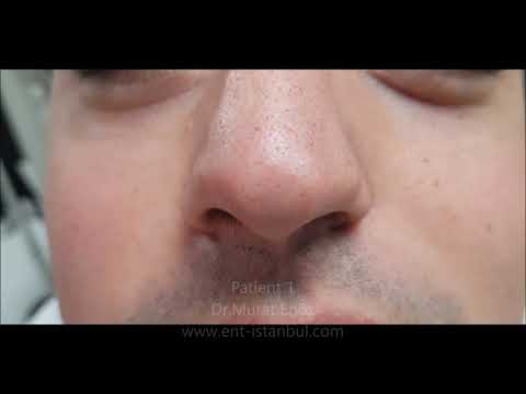 Nasal Valve Collapse and Treatment
