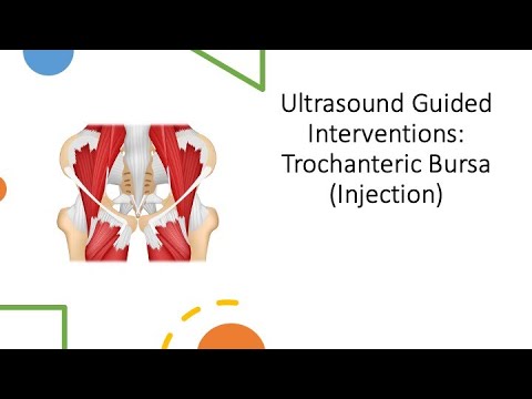 #ultrasound Guided Interventions: Trochanteric Bursa (Injection) #fyp # ...
