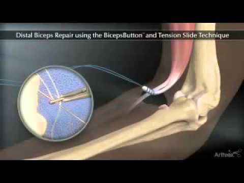 Distal Biceps Repair Animation - YouTube