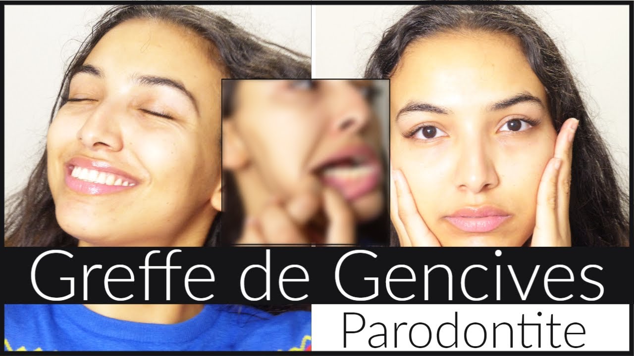 MON OPÉRATION DES GENCIVES 🦷 PARODONTITE, GREFFE D'OS, DOULEUR ...